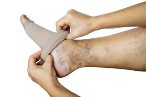 Como aliviar el dolor de varices | Centro de Estudios Vasculares